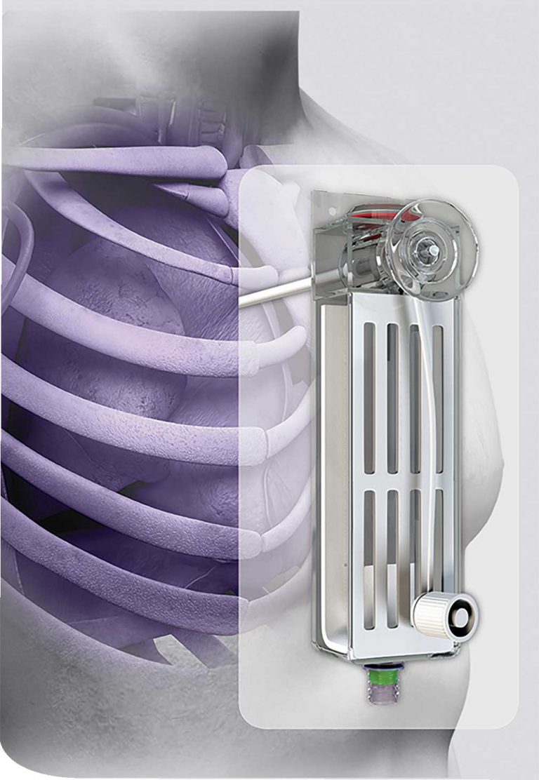 Uresil - medical device development