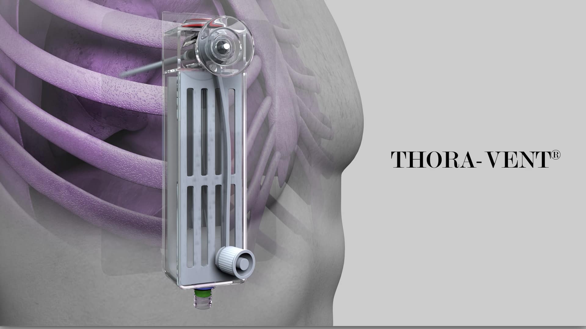 Uresil - medical device development